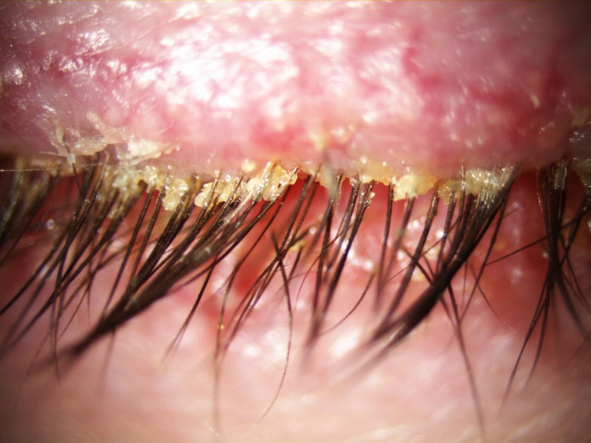Demodex Nedir? Belirtileri, Tedavisi ve Korunma Yöntemleri - Elos Klinik