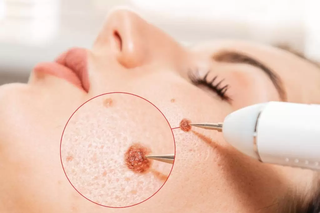 How Do Skin Moles Form: Causes, Diagnosis and Treatment Methods - Elos ...