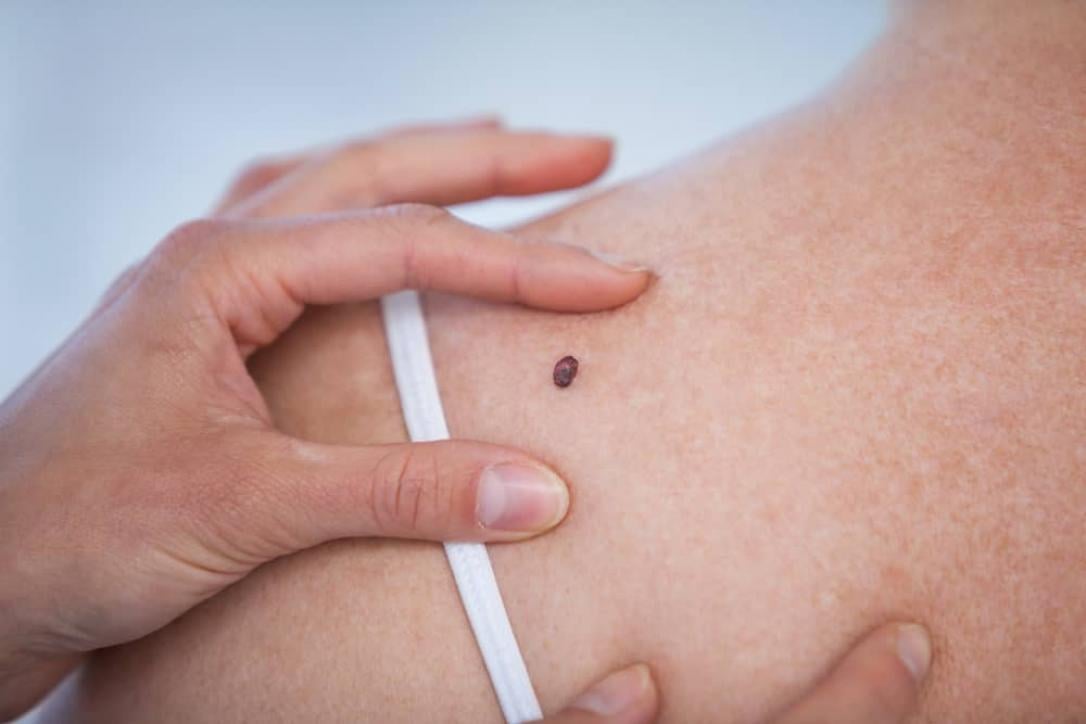 Melanom: Tanısı, Belirtileri, Türleri ve Tedavi Yöntemleri - Elos Klinik