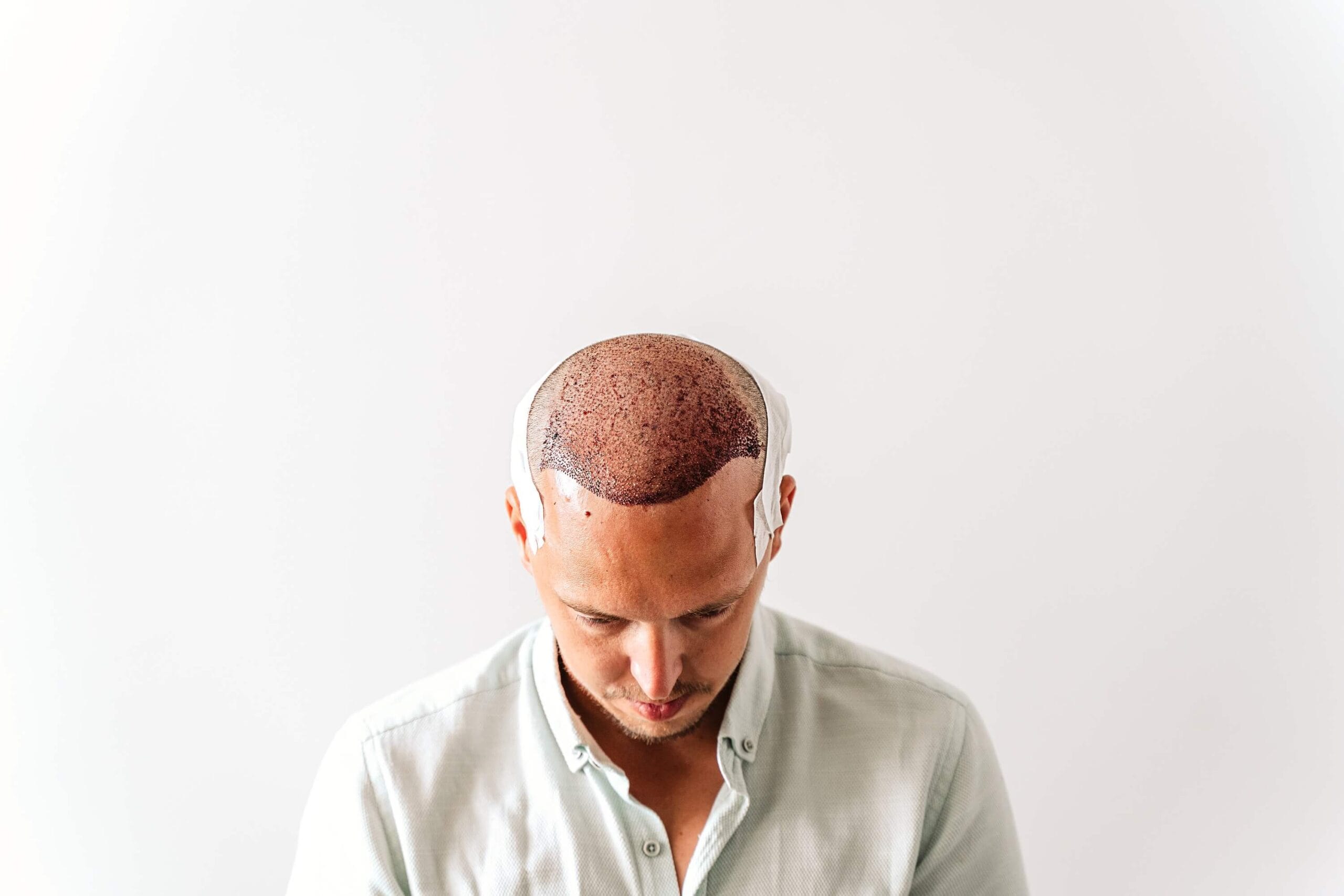 What is Hybrid Hair Transplantation and How is it Performed? - Elos Clinic